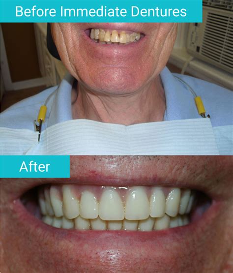 Custom Dentures And A Beautiful Smile At Nolan Denture Clinic London On