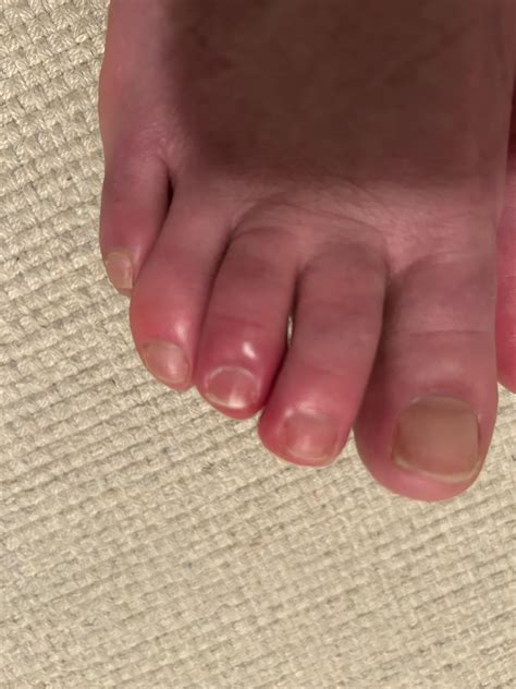Swollen Itchy Red Toes Accurate Chilblains Anyone Else Have A