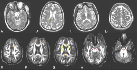 Figure 1 From Years Using Diffusion Tensor Imaging Measuring Brain