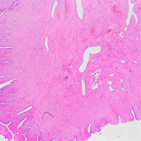 Congenital Midline Cervical Cleft Cmcc From The Upper Side Midline Download Scientific