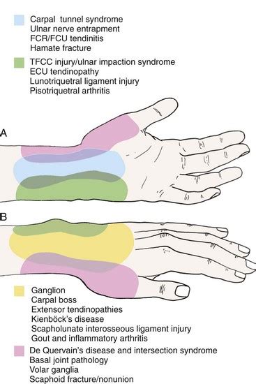 Hand And Wrist Pain Musculoskeletal Key