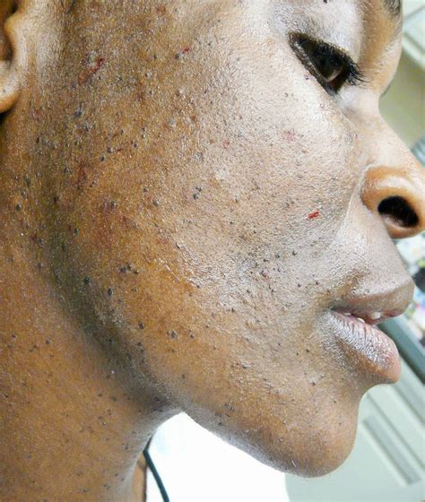 Video Dpn Treatment In Los Angeles By Dr Umar