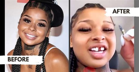 Chrisean Rock Before What Did She Do To Her Face 2024