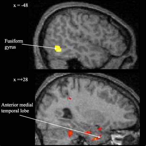 Figure 2 From Fmri Correlates Of The Episodic Retrieval Of Emotional