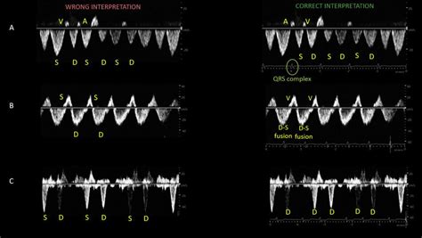 Mistakes In The Interpretation Of Hepatic Vein Doppler When There Is No
