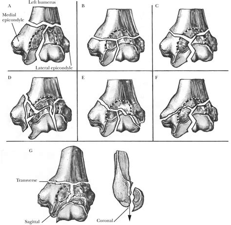 Classification Of Distal Humerus Fracture At David Prather Blog