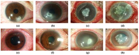 Deep Learning Approach In Image Diagnosis Of Pseudomonas Keratitis