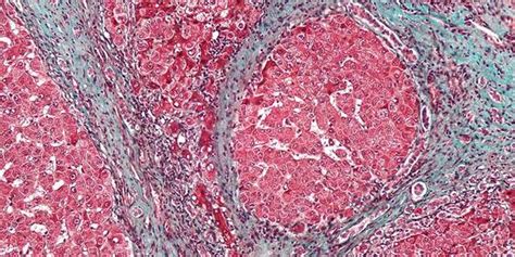 Multi Class Prediction Of Cirrhosis Outcomes Kaggle