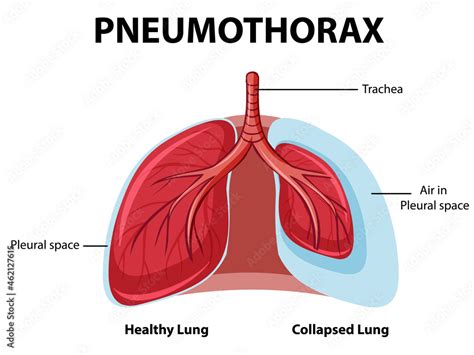 Pneumothorax Diagram With Collapsed Lung And Healthy Lung Stock Vector