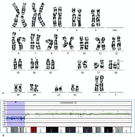 the results of karyotype analysis and array cgh in case 1 a the download scientific diagram