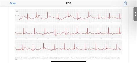 Borderline Right Axis Deviation R Readmyecg