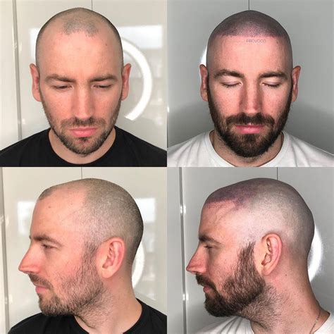 Transform Receding Hairline With Smp Scalp Provoco