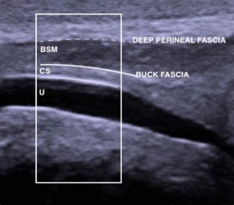 Ultrasound Imaging Of Male Urethral Stricture Disease A Narrative
