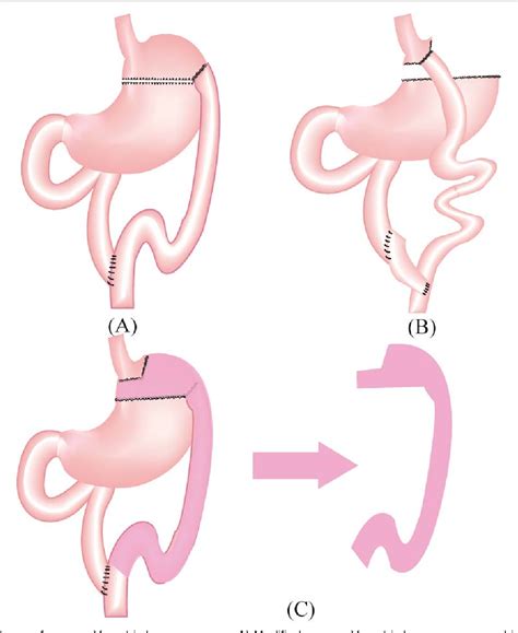 Figure 1 From Laparoscopic Roux En Y Gastric Bypass For Uncontrolled