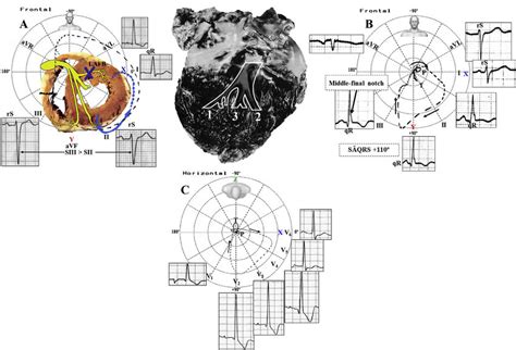 Lafb Fig 1 A Causes Left Axis Deviation In The Frontal Plane Download Scientific Diagram