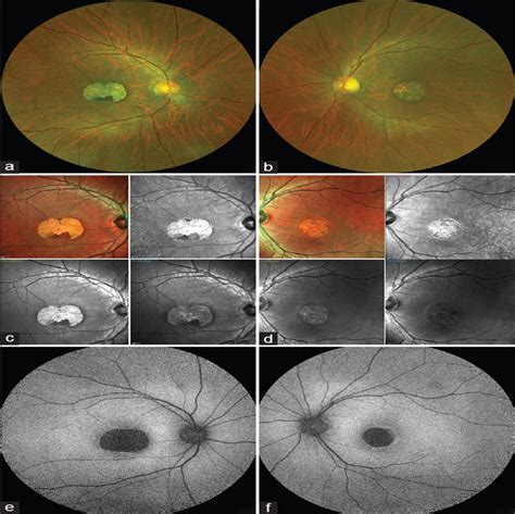 Multimodal Imaging In Central Areolar Choroidal Dystrophy Oman