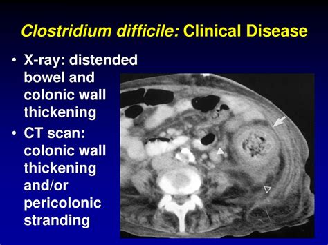 Ppt Clostridium Difficile Epidemiology And Clinical Spectrum