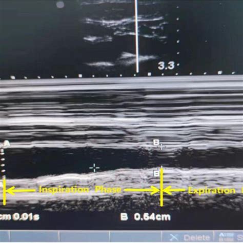 M Mode Assessment Of The Subclavian Vein Download Scientific Diagram