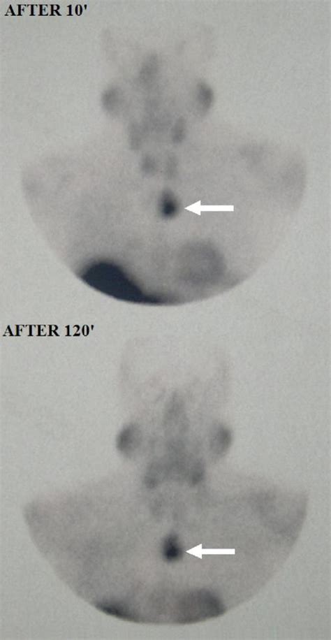 Parathyroid Scintigraphy 99m Tc Mibi Demonstrated Pathological And