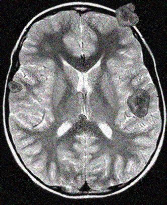 Tumor Object Detection Dataset By PFE