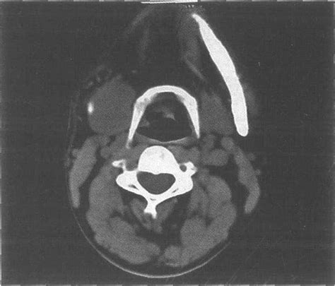 6 颌下腺混合瘤 Ct诊断 医学