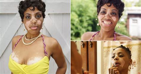 Woman With Rare Skin Condition Says Men Find It Irresistible But