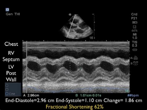 Using Pocus For Ejection Fraction Estimation — Brown Emergency Medicine Blog
