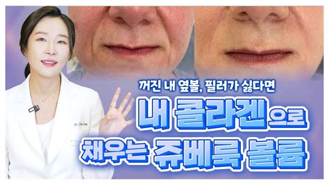 자글자글한 주름과 푹꺼진 내 옆볼😵‍💫 ‘필러대신 쥬베룩 볼륨으로 해결하자 나의 콜라겐으로 볼륨을 채울 수 있다⁉️ Youtube