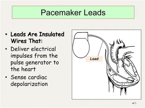 Temporary Pacemaker Easy To Learn For Picu Ppt