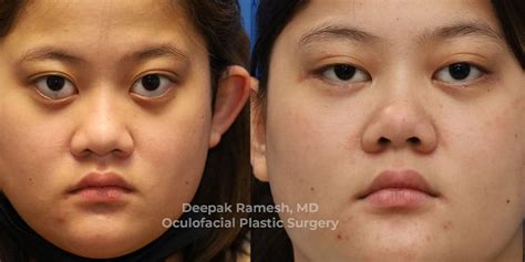 Orbital Decompression Center For Eye And Facial Plastic Surgery