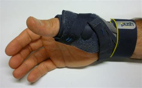Ulnar Collateral Ligament Thumb Splint