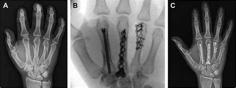 Intramedullary Screw Fixation Of Metacarpal And Phalangeal Fractures Hand Clinics