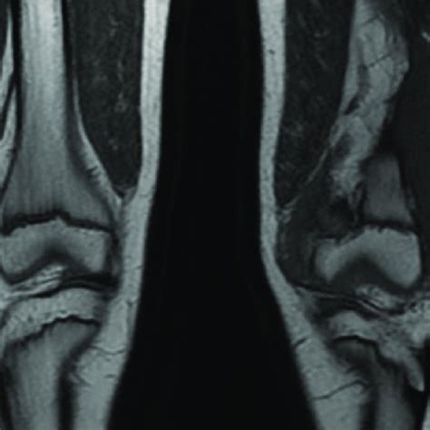Left Suprapatellar Effusion And Nodular Synovial Thickening That May Be