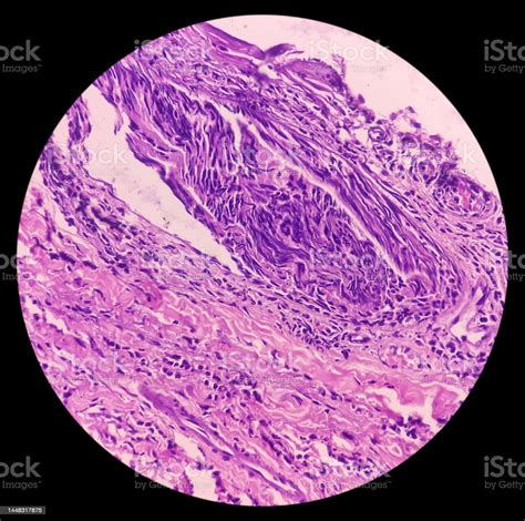 Microscopic View Of Cheek Cyst Mucous Retention Cyst Benign Pathologic