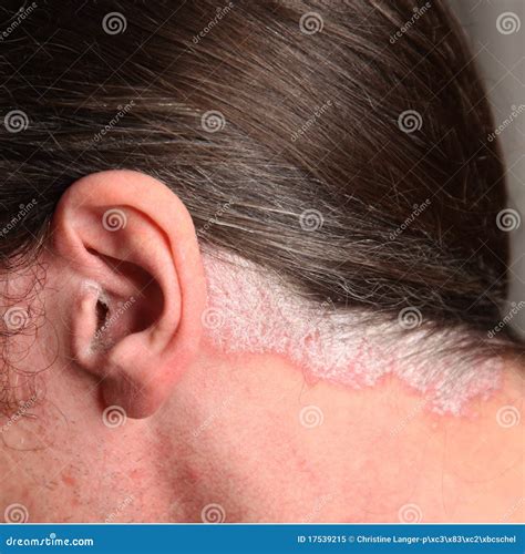 Psoriasis In The Ear And Neck Stock Image Image Of Finger Relief