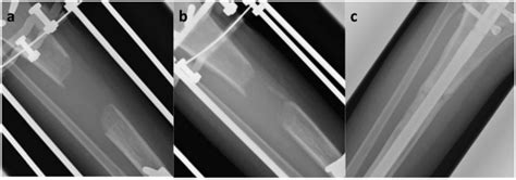 Serial Plain Radiographs Of Proximal Tibial Bone Defect Download Scientific Diagram