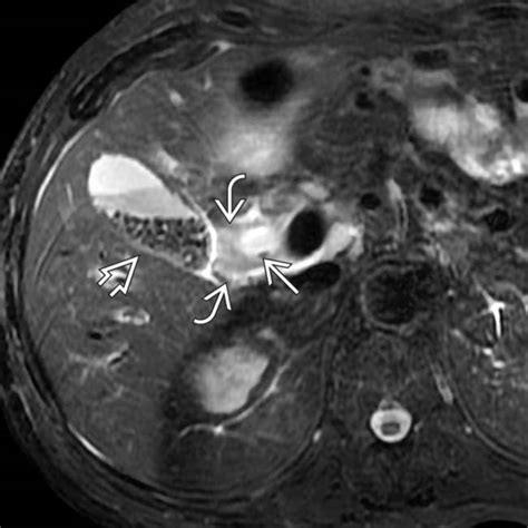 Ascending Cholangitis Clinical Gate