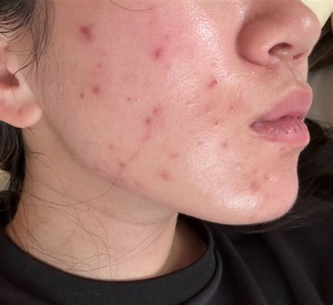 시술수술 질문 지성피부민감성피부입 강남언니 1등 성형수술and피부시술 정보앱