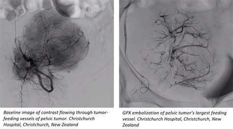 New Liquid Embolic Multi Center Trial Successfully Enrolls Final Patient