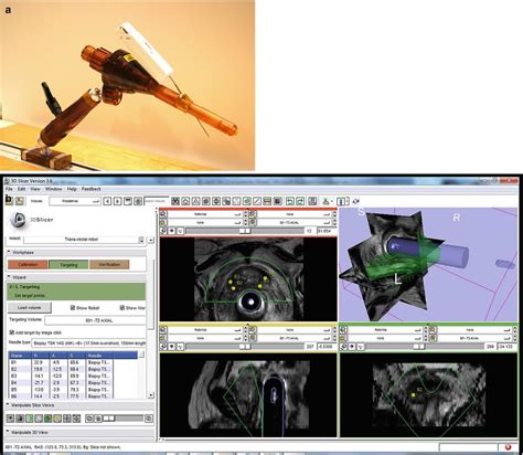 Mr Imaging And The Biopsy Of Prostate Cancer Radiology Key