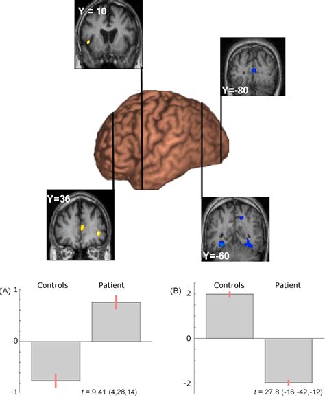 In A World Of “blind Imagination” The Science Of Aphantasia Neuwrite