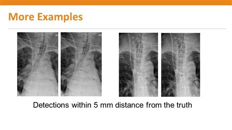 Identifying Carina On X Ray At Savannah Cawthorne Blog