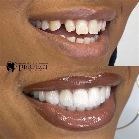 Porcelain Veneers Artofit