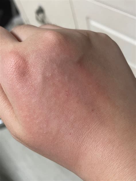손등 두드러기 지식in