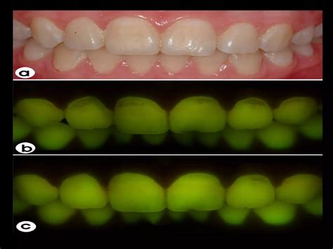 Early Detection Diagnosis And Quantification Of Dental Caries Ppt