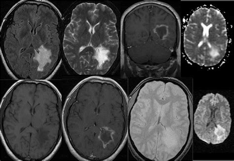 Tumefactive Demyelination