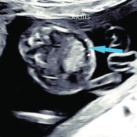 Ultrasound Showing Fetal Scalp Edema At 19 Weeks Gestation Arrow Download Scientific Diagram