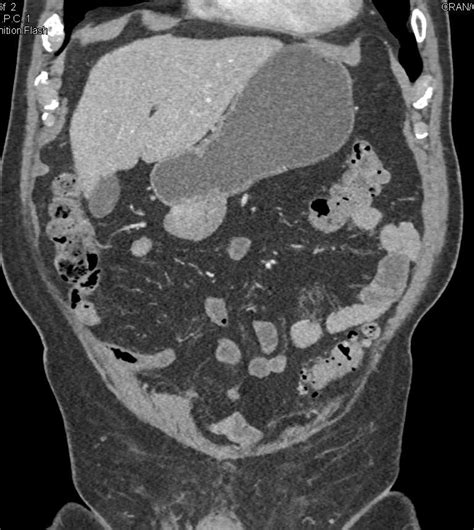 Exophytic Gastric Gist Tumor Stomach Case Studies Ctisus Ct Scanning