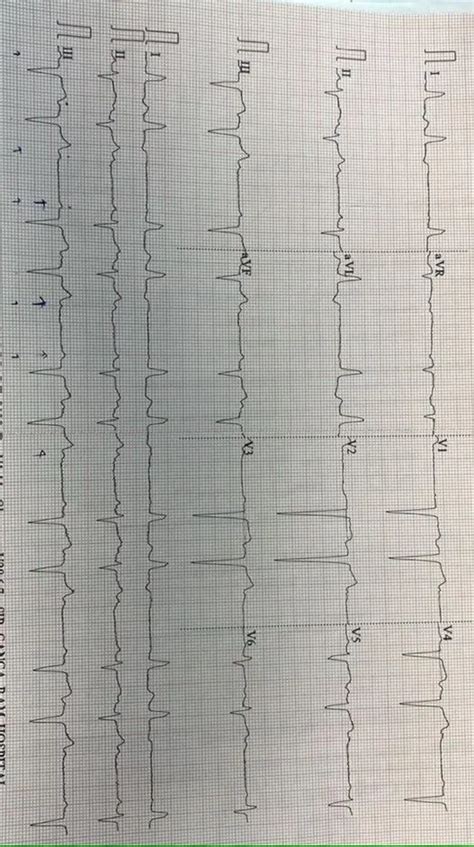 Conduction System Pacing Csp Is A Specialized Pacing Technique