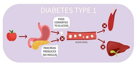 Type 1 And Type 2 Diabetes GCSE Biology Revision